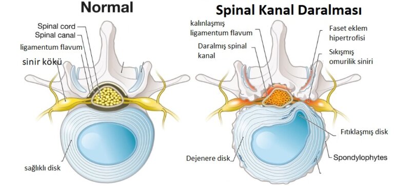 Kanal Daralması (Spinal Stenoz) Nedir? Belirtiler ve Tedavi